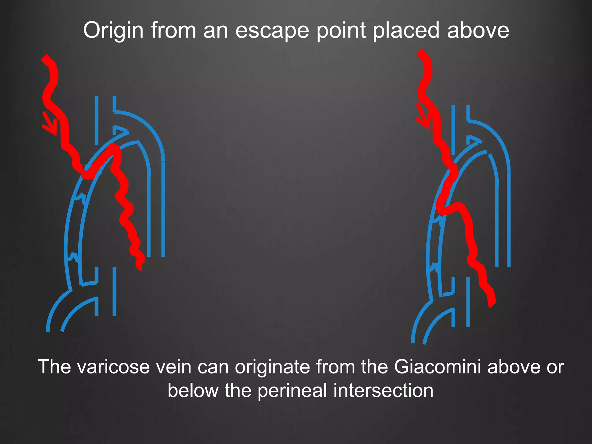 Giacomini varicose veins, hemodynamic patterns and strategy terapy | PPTX