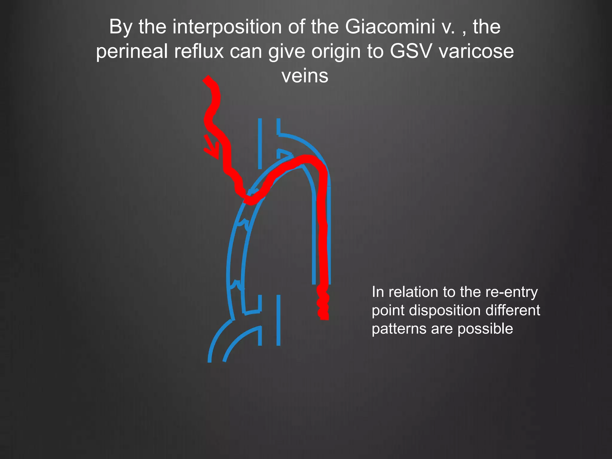 Giacomini varicose veins, hemodynamic patterns and strategy terapy | PPTX