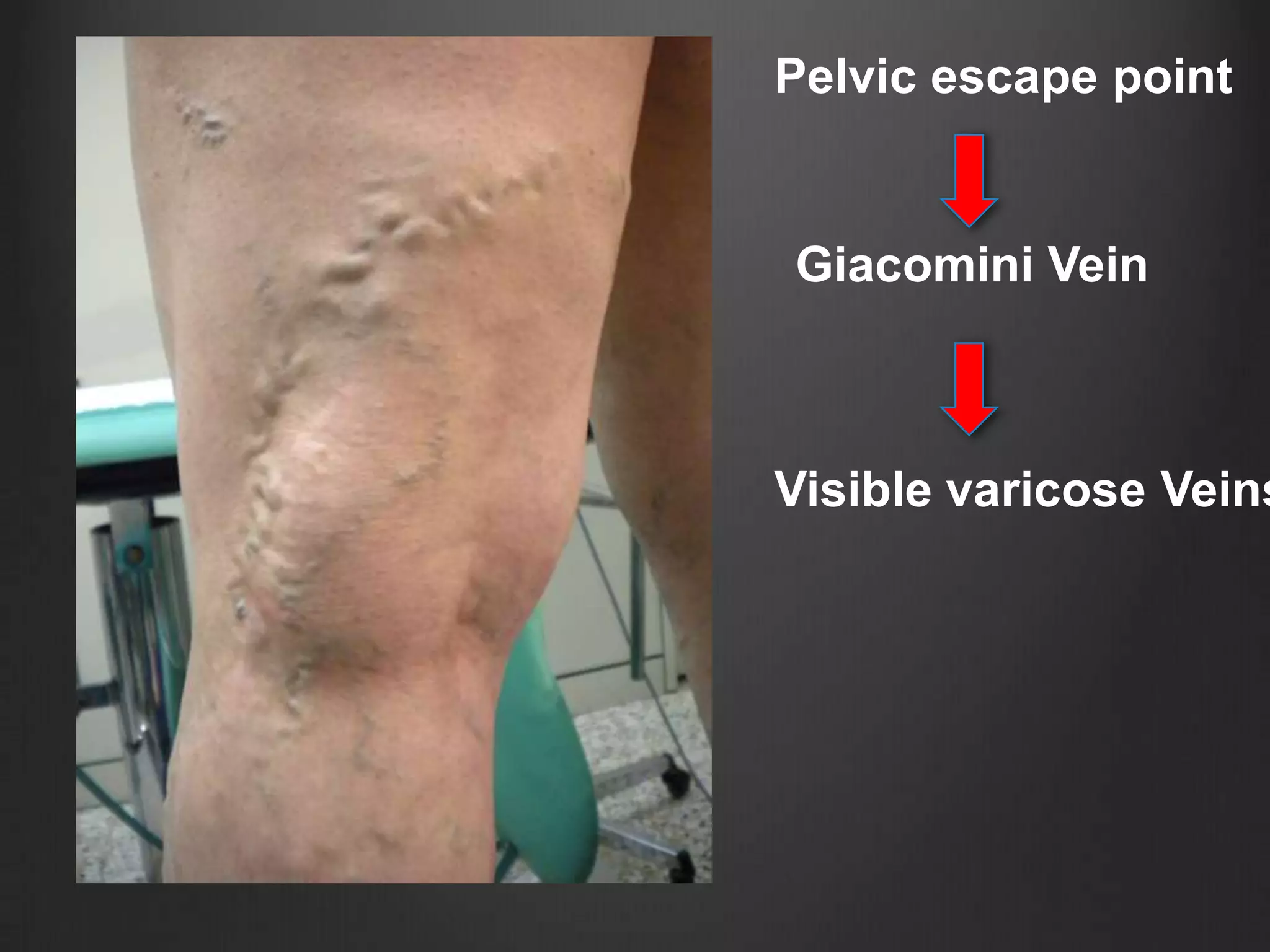 Giacomini varicose veins, hemodynamic patterns and strategy terapy | PPTX