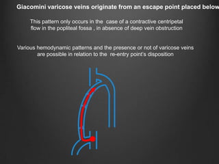 Giacomini varicose veins, hemodynamic patterns and strategy terapy | PPTX