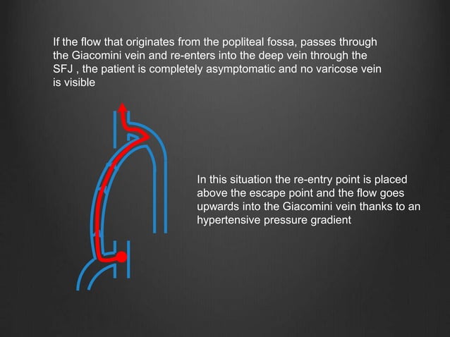 Giacomini varicose veins, hemodynamic patterns and strategy terapy | PPTX