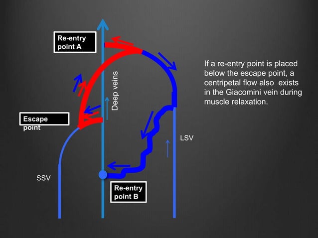 Giacomini varicose veins, hemodynamic patterns and strategy terapy | PPTX