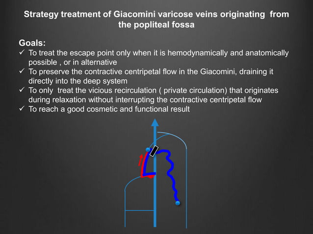 Giacomini varicose veins, hemodynamic patterns and strategy terapy | PPTX