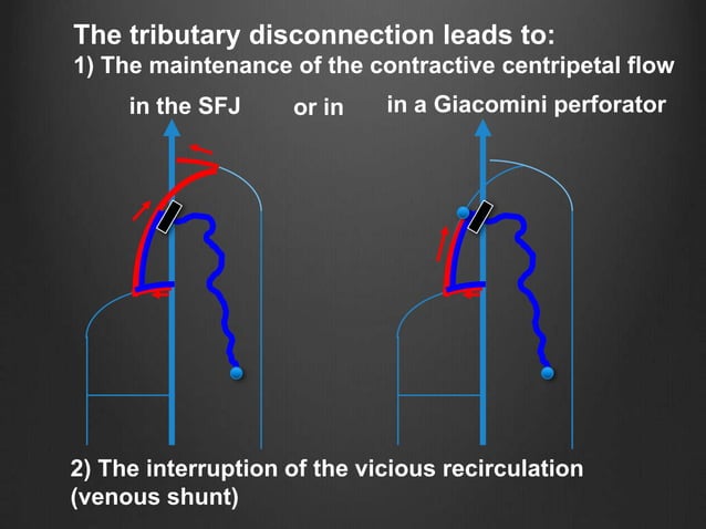 Giacomini varicose veins, hemodynamic patterns and strategy terapy | PPTX