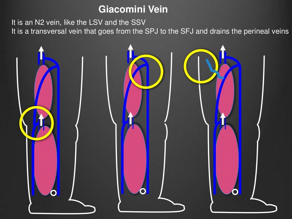 Giacomini varicose veins, hemodynamic patterns and strategy terapy