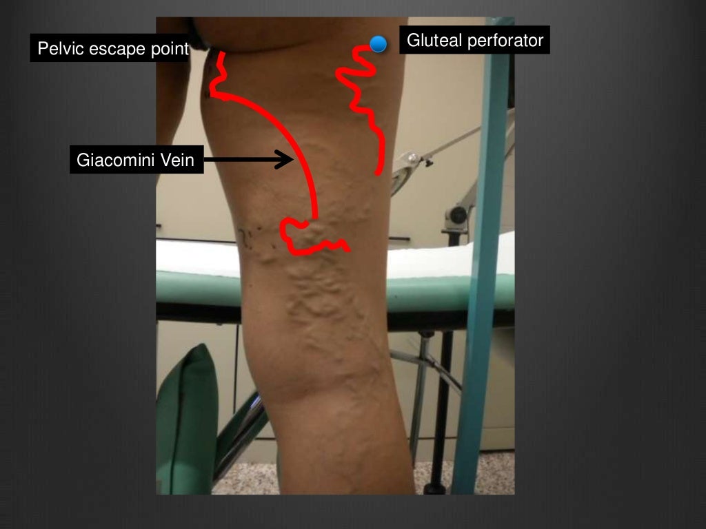 Giacomini varicose veins, hemodynamic patterns and strategy terapy
