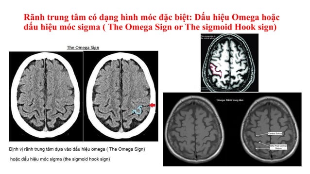 Giai phau mri so nao.dinh vi ranh trung tam. Drduong | PDF
