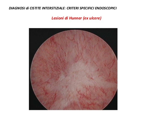 Bladder Pain Syndrome/Cistite Interstiziale fisiopatologia e trattame…