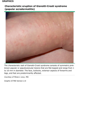 Gianotti-Crosti syndrome vs PPGSS syndrome | PDF