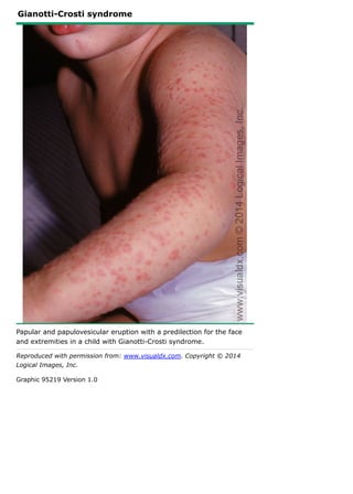 Gianotti-Crosti syndrome vs PPGSS syndrome | PDF