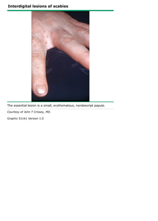 Gianotti-Crosti syndrome vs PPGSS syndrome | PDF