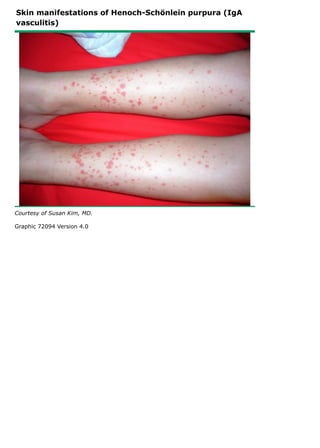 Gianotti-Crosti syndrome vs PPGSS syndrome | PDF