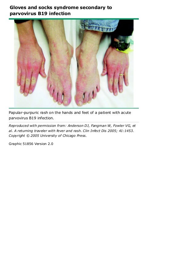 Gloves And Socks Syndrome Icd 10 at Gemma Dalton blog