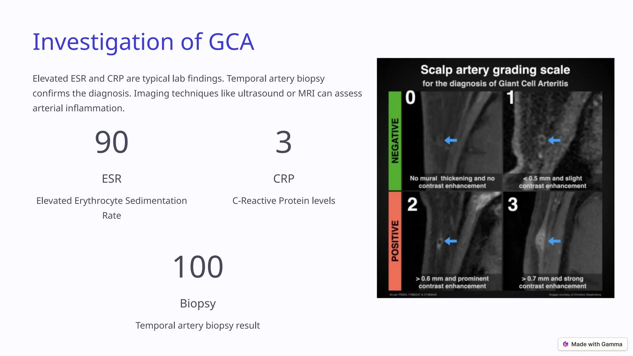 Giant-Cell-Arteritis-A-Comprehensive-Overview.pptx