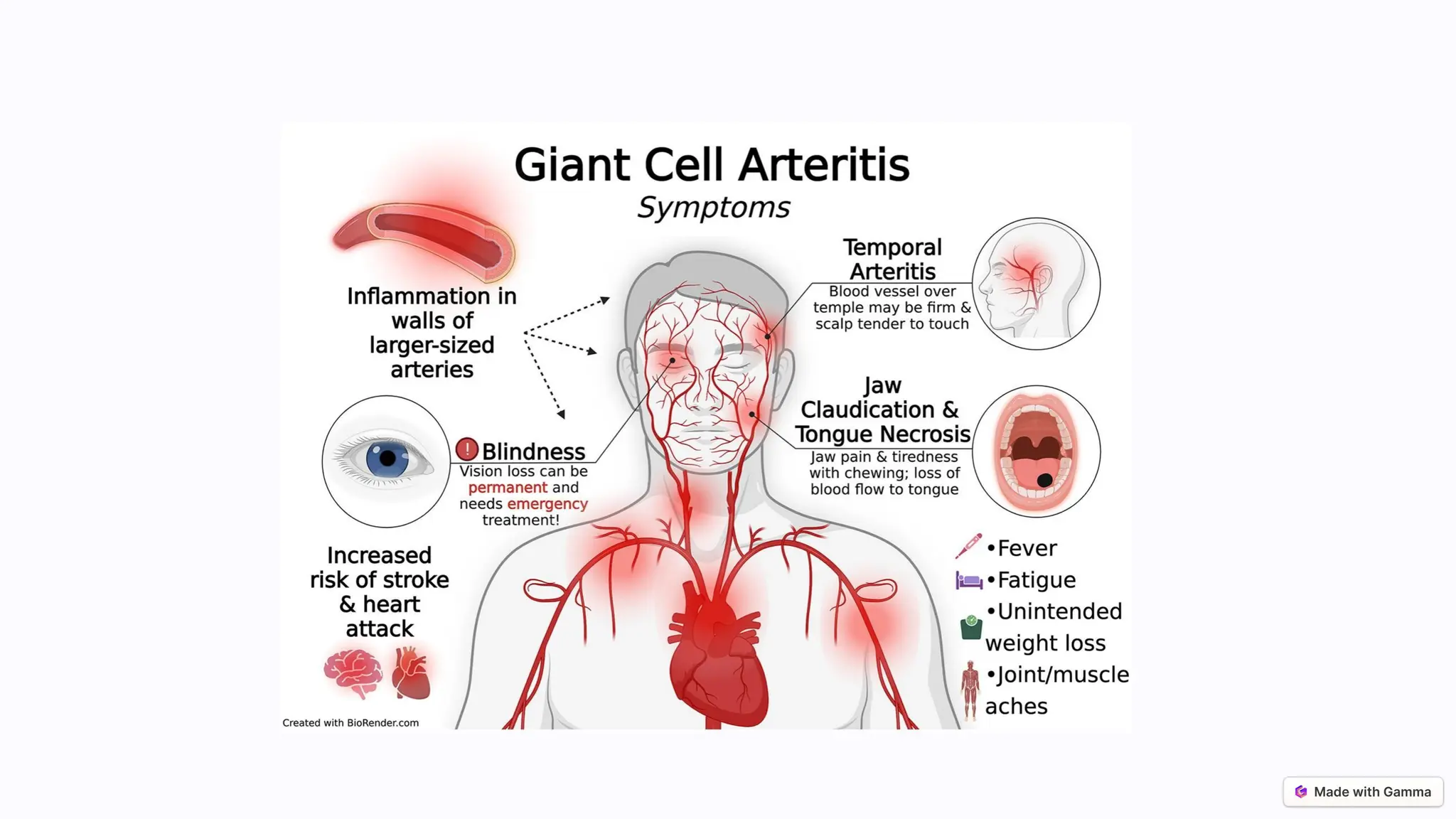 Giant-Cell-Arteritis-A-Comprehensive-Overview.pptx