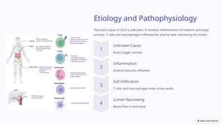 Giant-Cell-Arteritis-A-Comprehensive-Overview.pptx