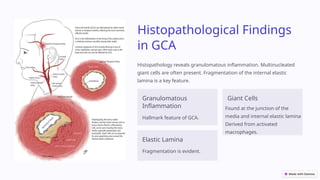 Giant-Cell-Arteritis-A-Comprehensive-Overview.pptx