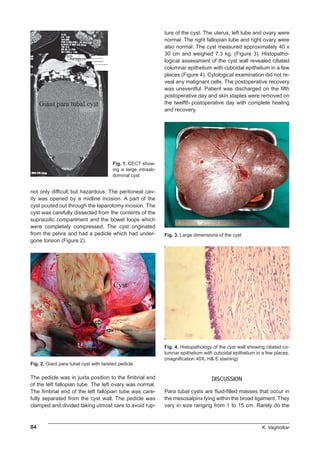 Giant-Para-Tubal-Cyst-in-an-Adolescent-Girl-Mimicking-A-Mesenteric-Cyst ...