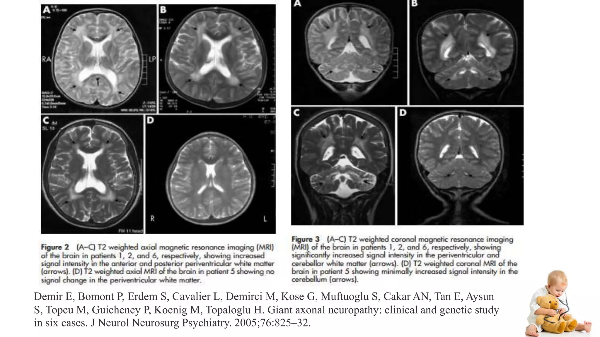 Giant axonal neuropathy | PPTX