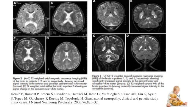 Giant axonal neuropathy