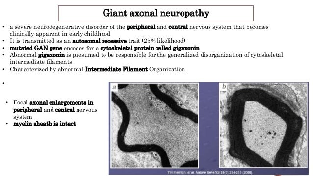 Giant axonal neuropathy