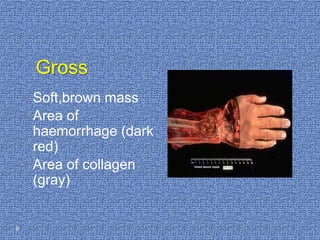 Giant Cell Tumor Gross