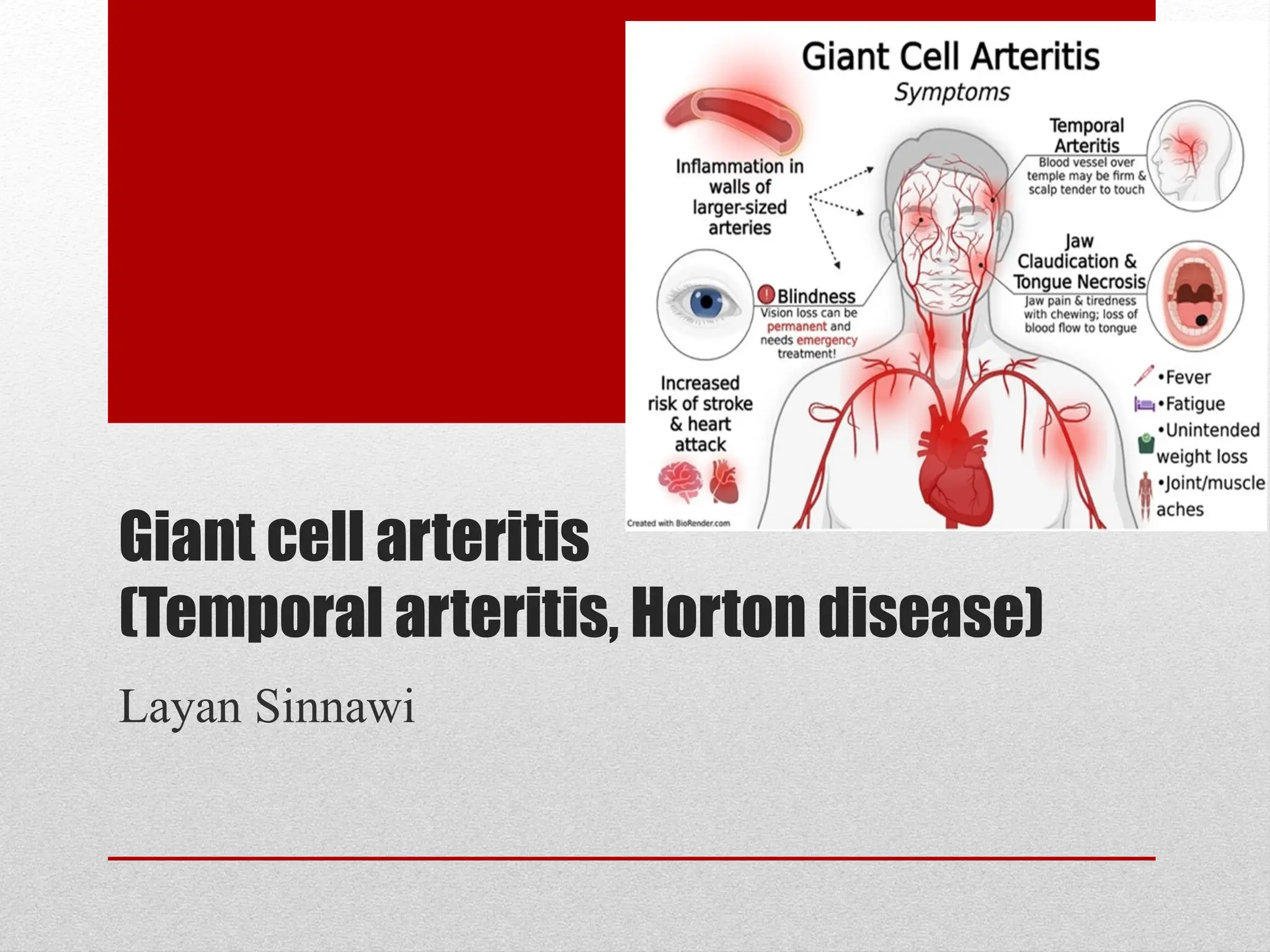 Giant cell arteritis disease presentation.pptx