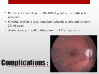 Giant cell arteritis disease presentation.pptx