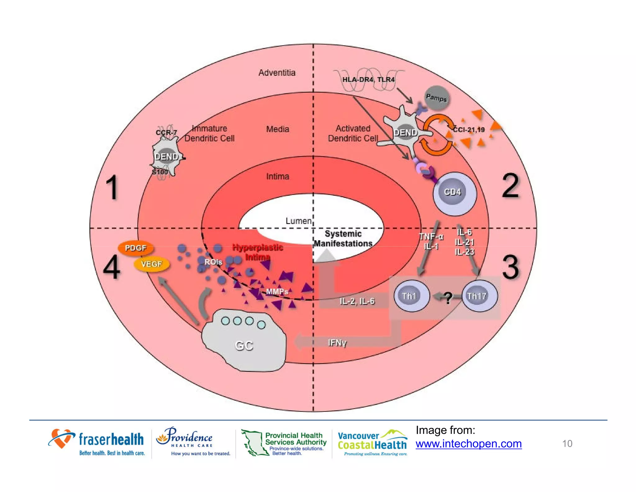 Giant-Cell Arteritis: What's the evidence for steroid-sparing therapies? (Case Presentation) | PDF