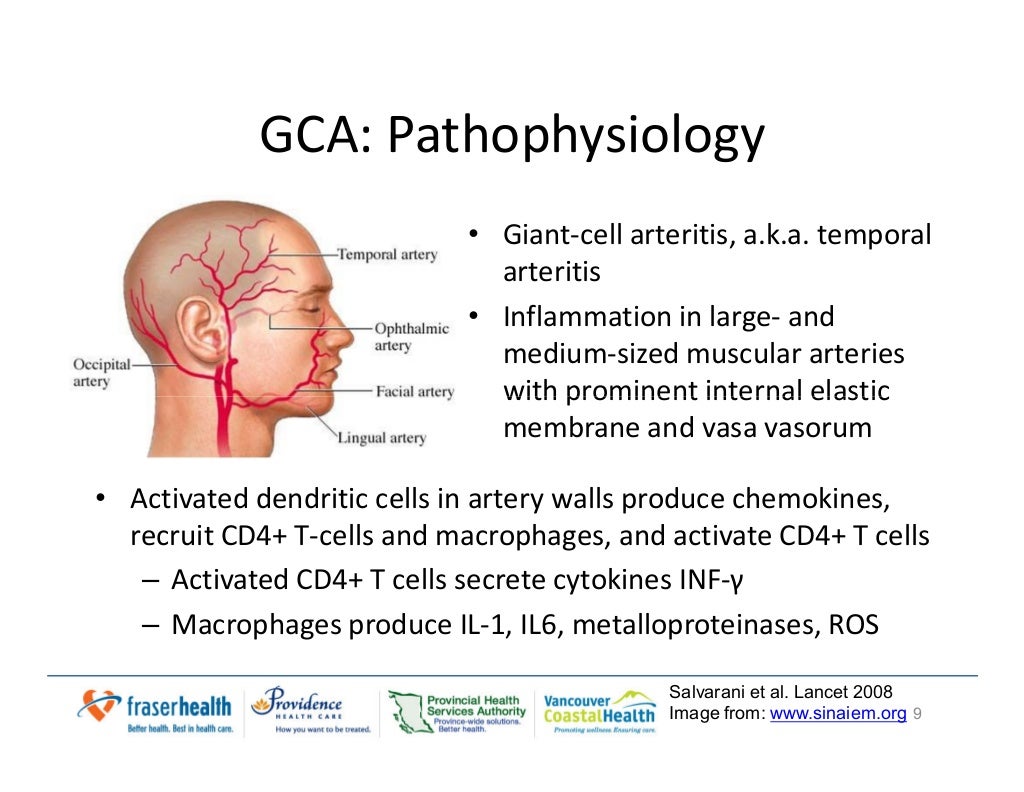 Giant-Cell Arteritis: What's the evidence for steroid-sparing therapi…