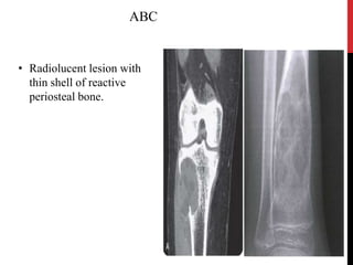 Giant cell lesion.pptx