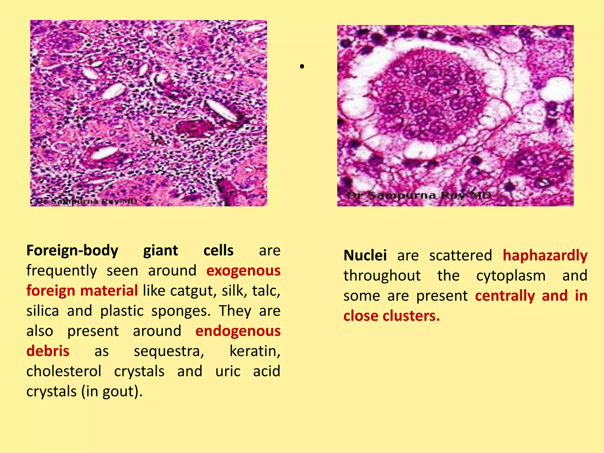 GIANT CELL LESIONS.pptx