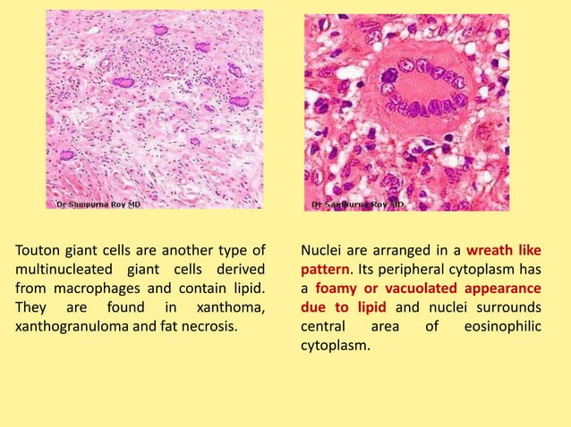 GIANT CELL LESIONS.pptx