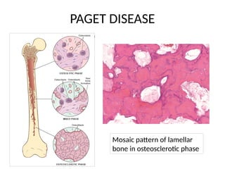 Giant cell lesions of bone new.pptx fully | PPTX