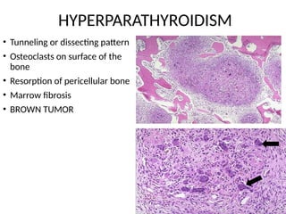 Giant cell lesions of bone new.pptx fully | PPTX