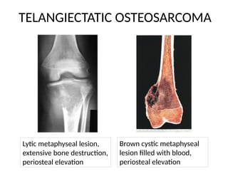 Giant cell lesions of bone new.pptx fully | PPTX