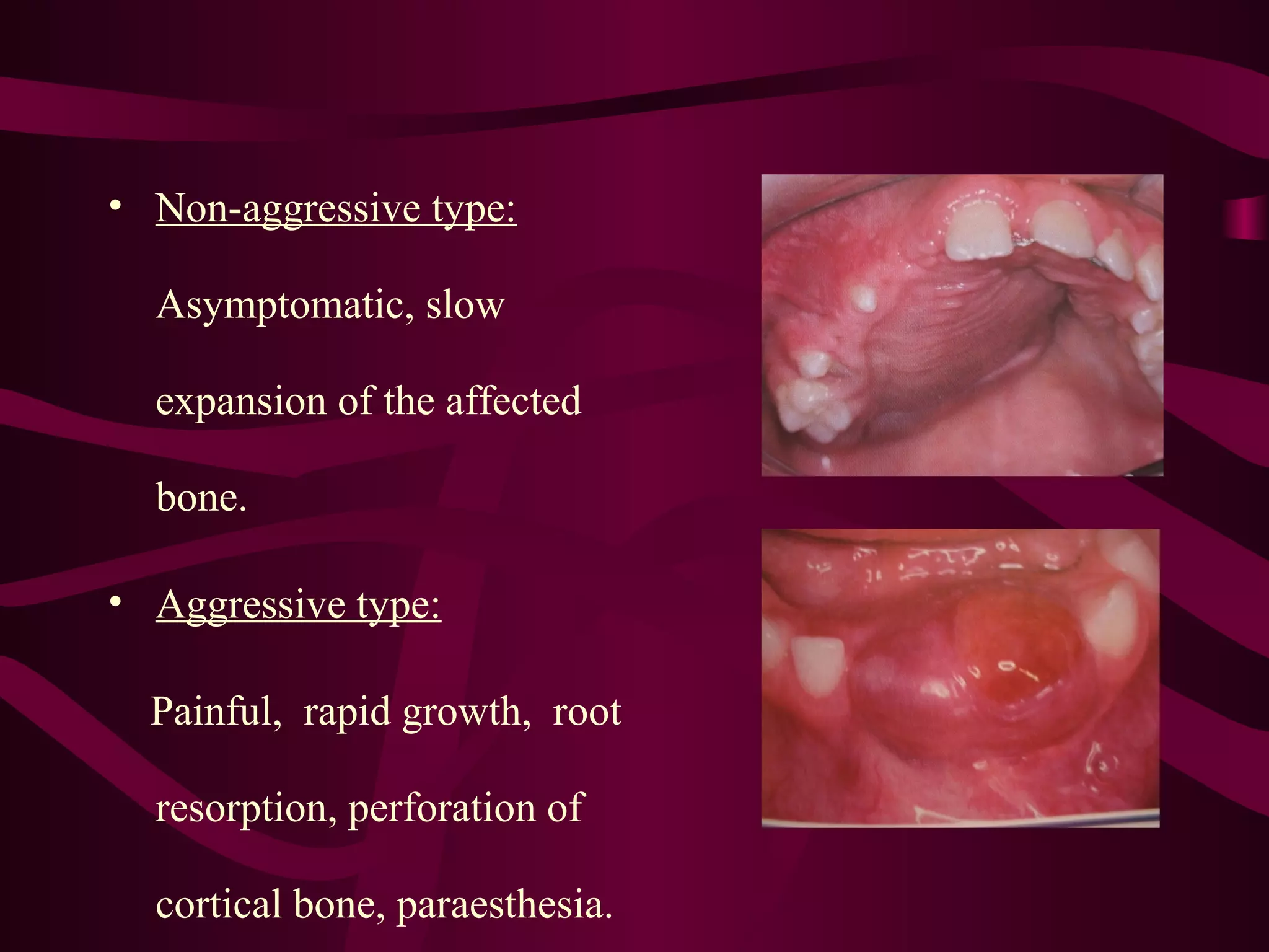 Giant cell lesion’s of jaw | PPT