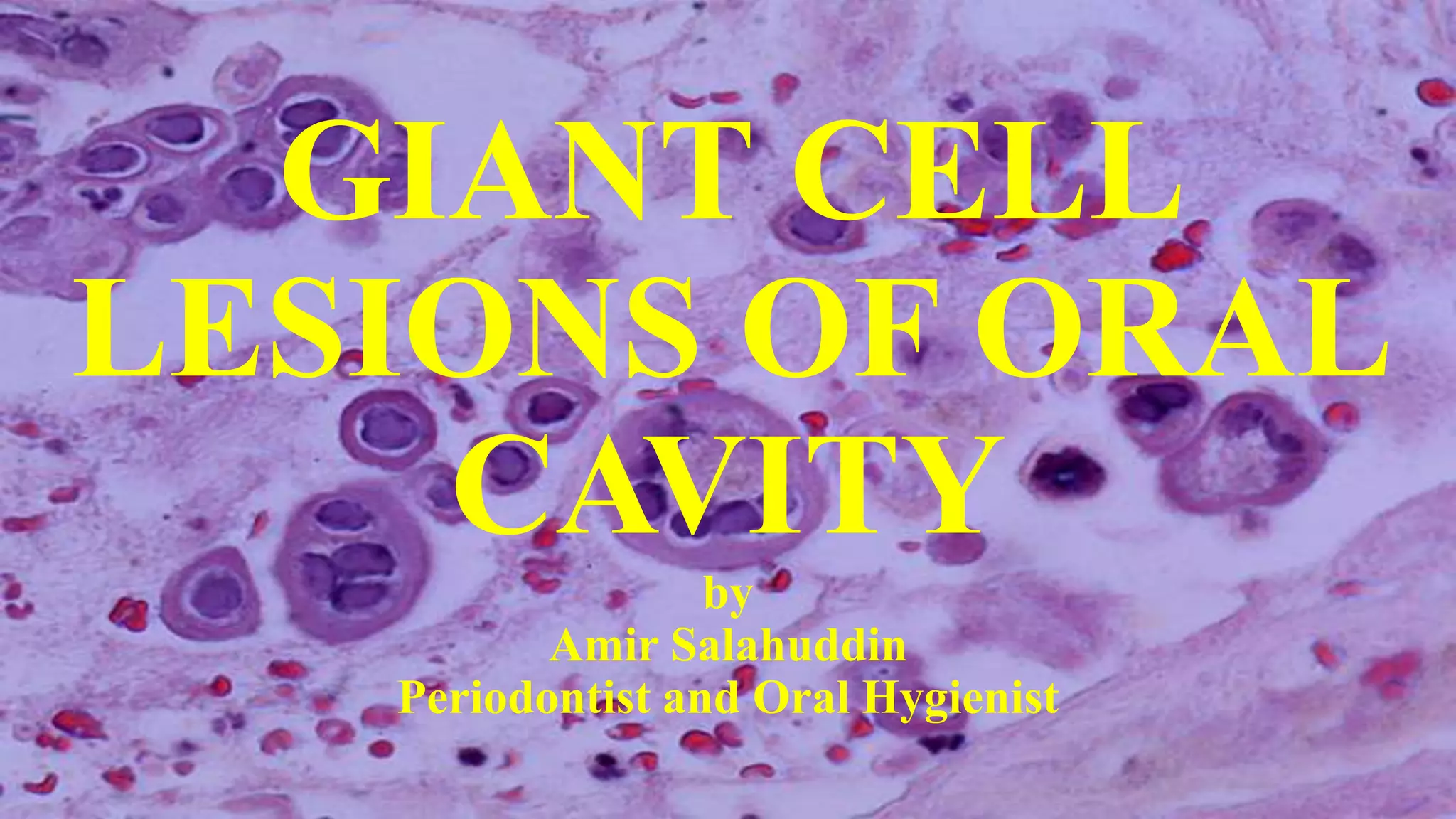 Giant cell lesions of oral cavity | PPTX