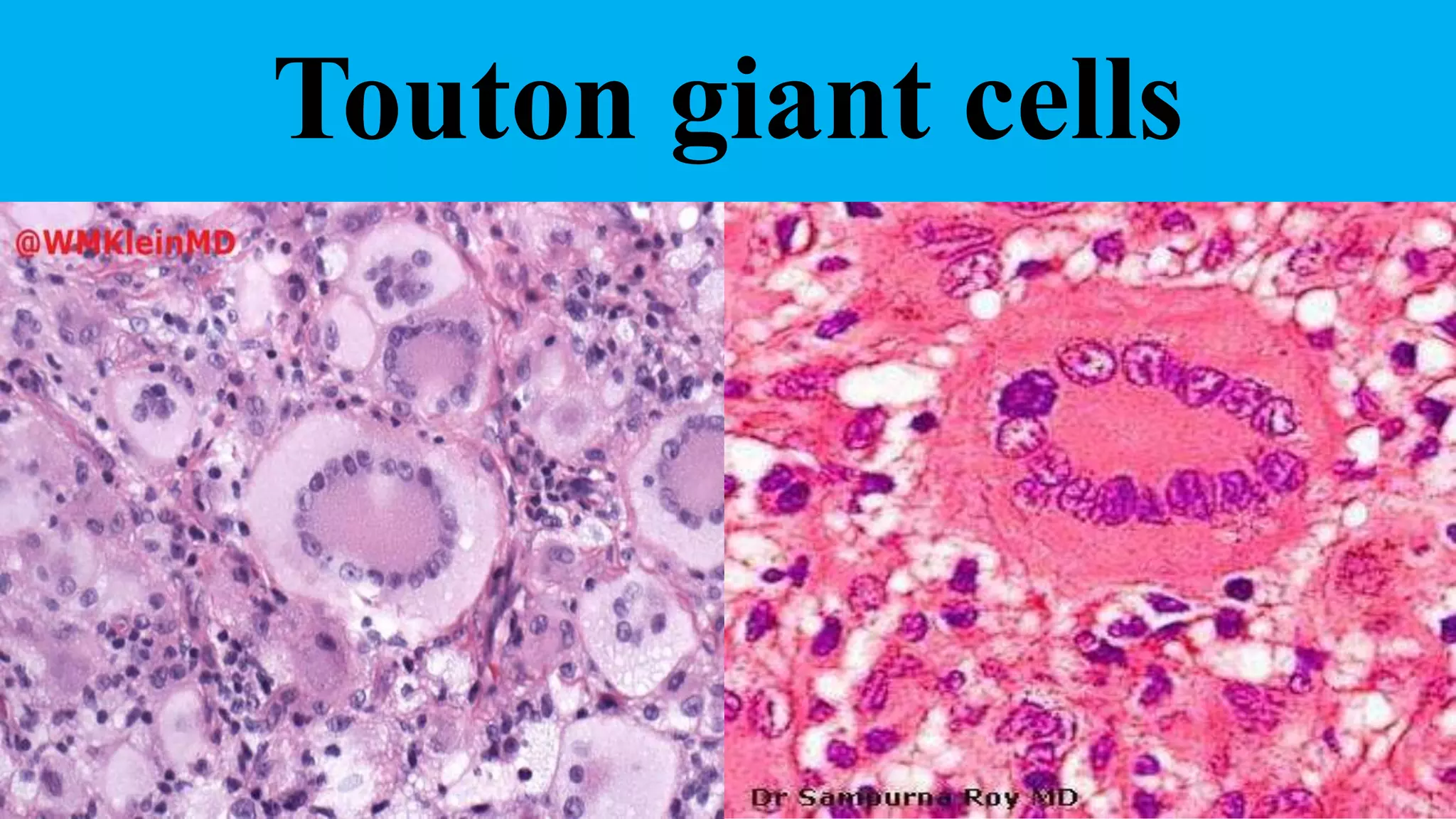 Giant cell lesions of oral cavity | PPTX
