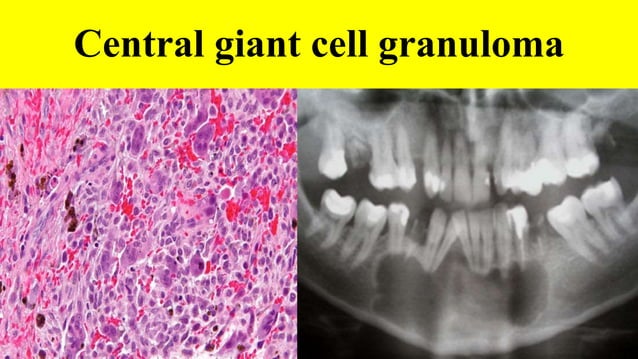 Giant cell lesions of oral cavity | PPTX