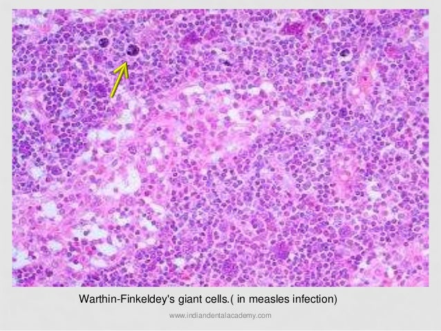 Types of Giant cells /endodontic courses