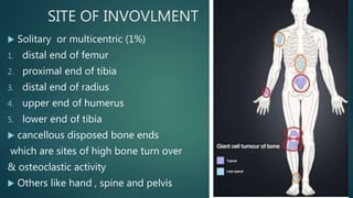 Giant cell tumor | PPTX