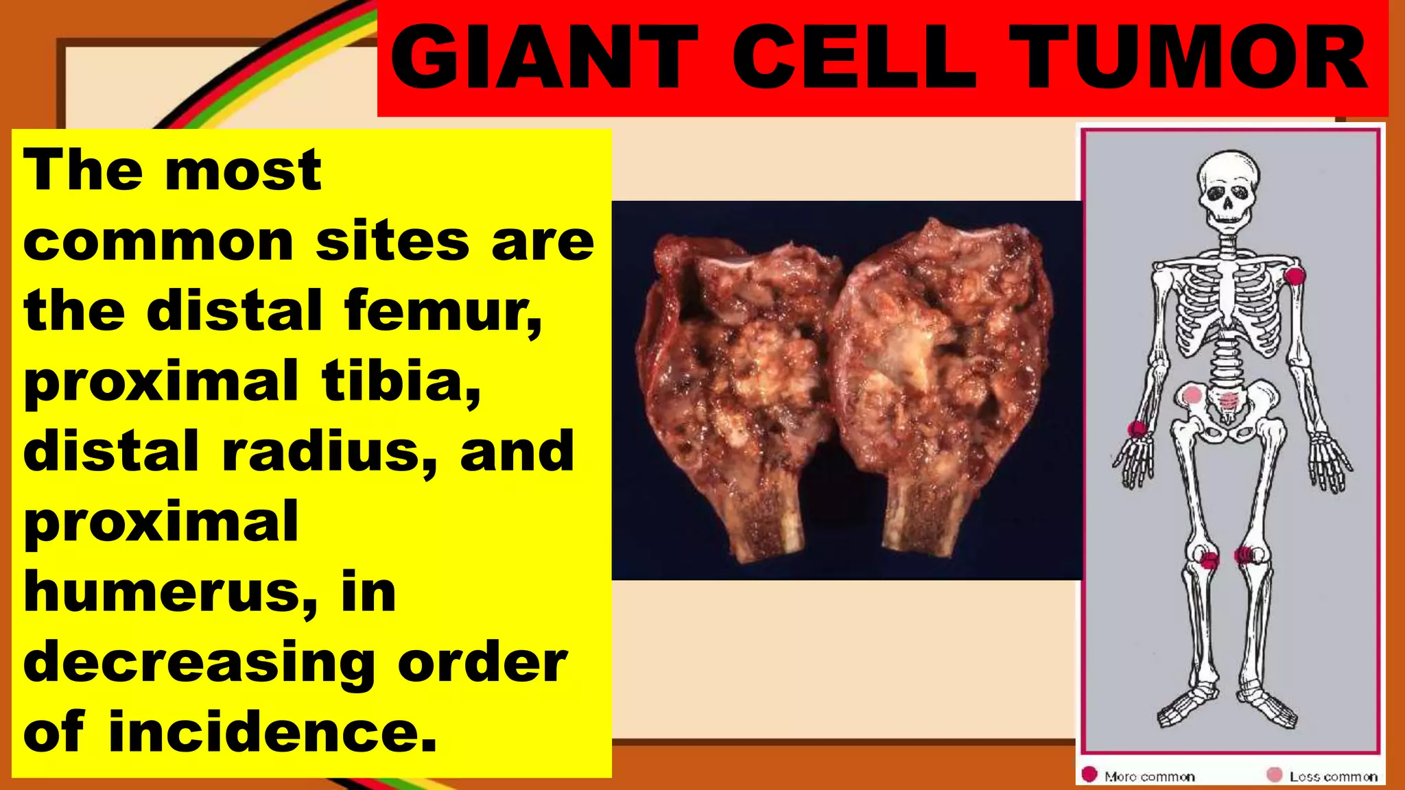 Giant cell tumor | PPTX