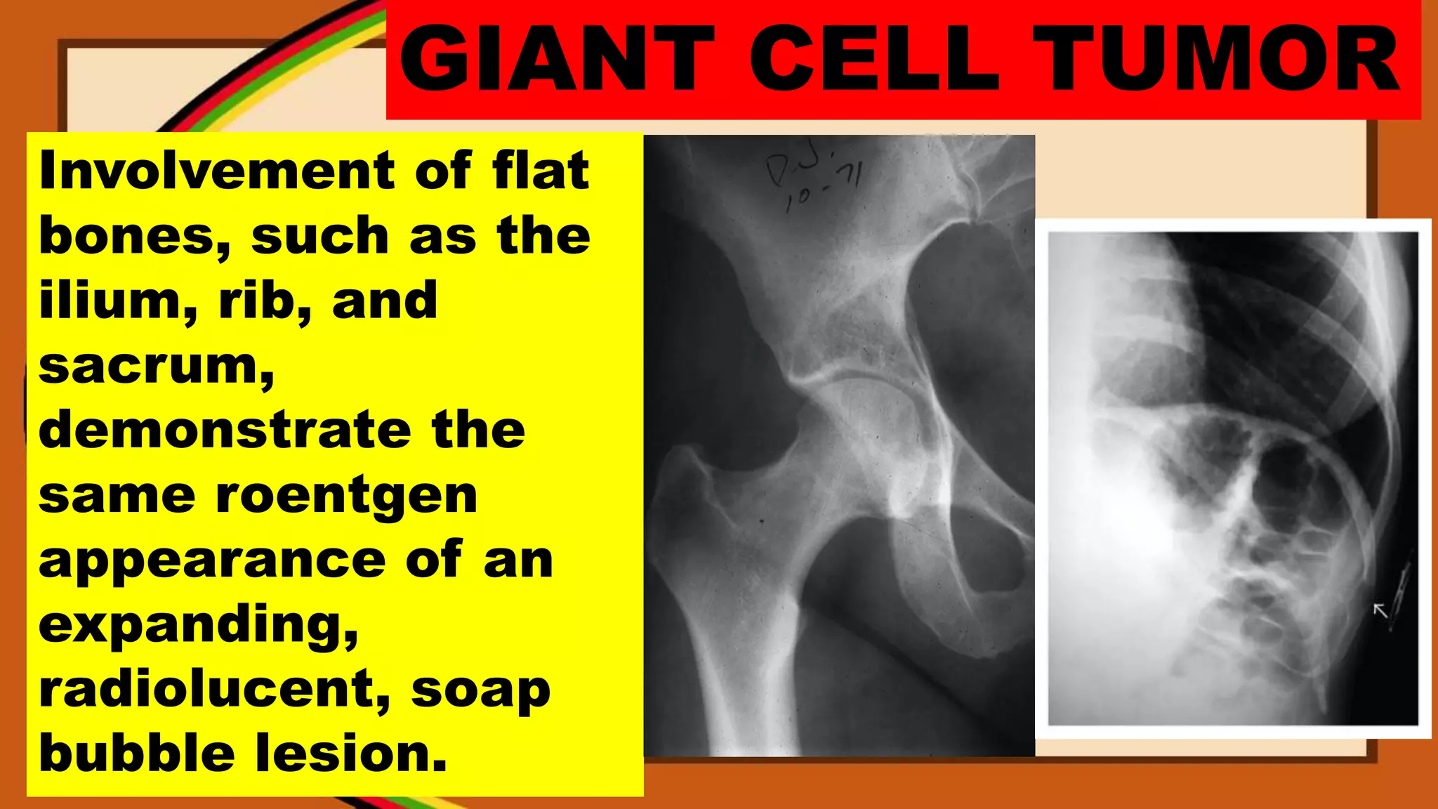 Giant cell tumor | PPTX