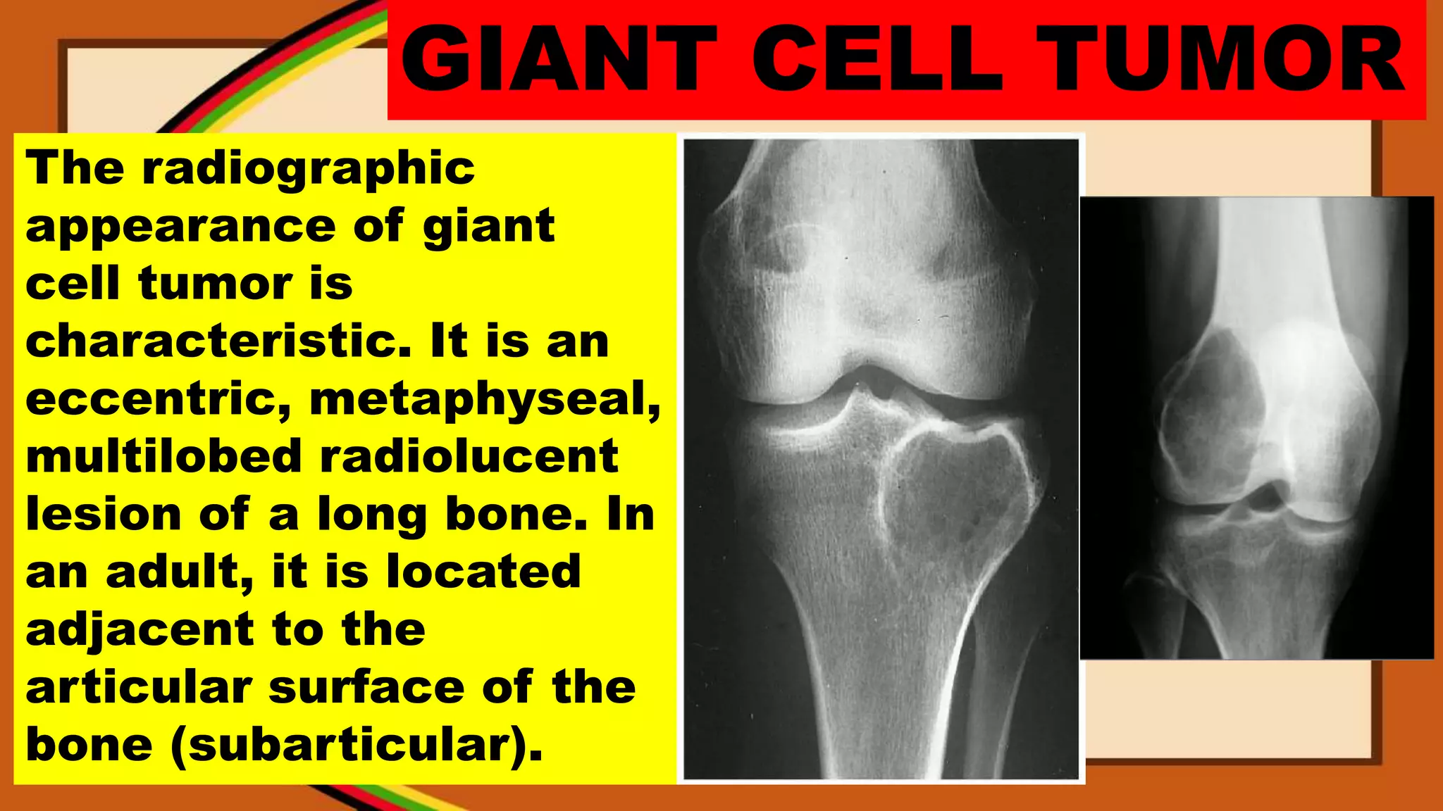 Giant cell tumor | PPTX