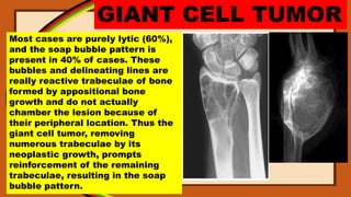 Giant cell tumor | PPTX