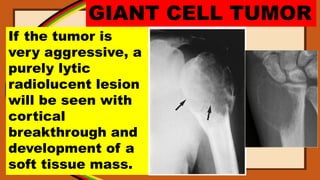 Giant cell tumor | PPTX