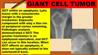 Giant cell tumor | PPTX