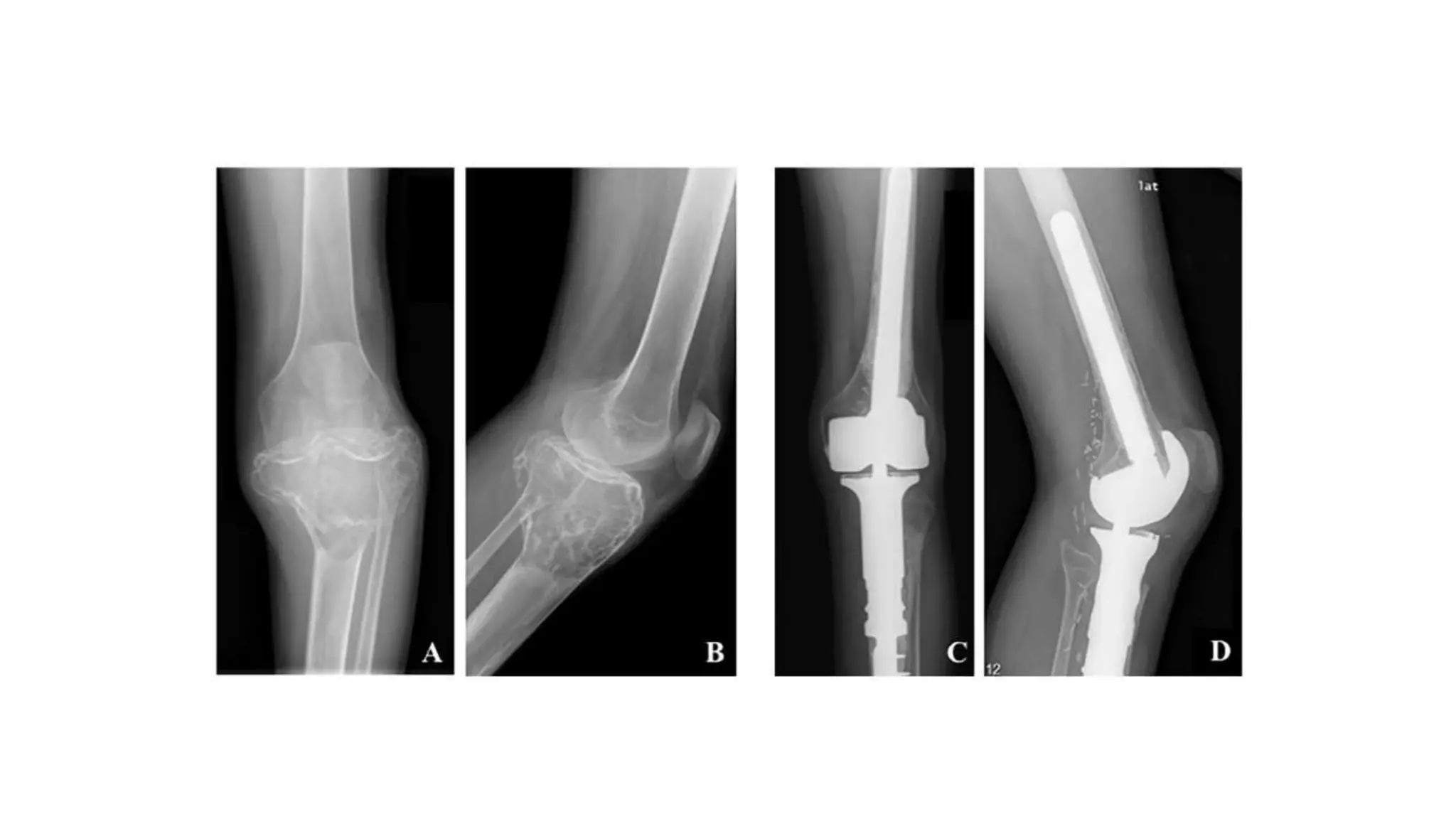 Giant Cell Tumor Of Bonepptx