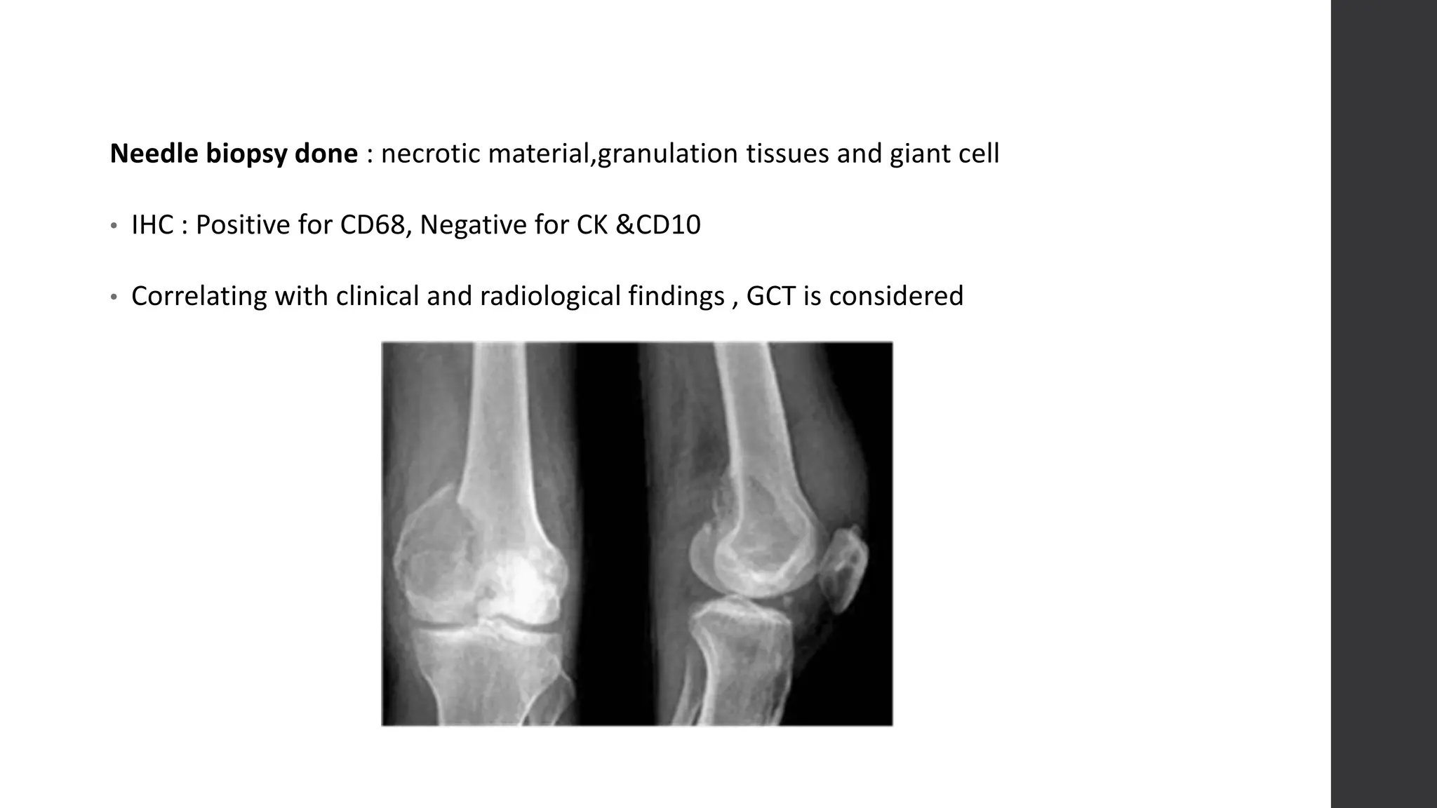 GIANT CELL TUMOR OF DISTAL FEMUR WITH PATHOLOGICAL.pptx